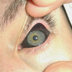 Eyeball Tattoo: All About Corneal or Scleral Tattoo - Body Art Guru