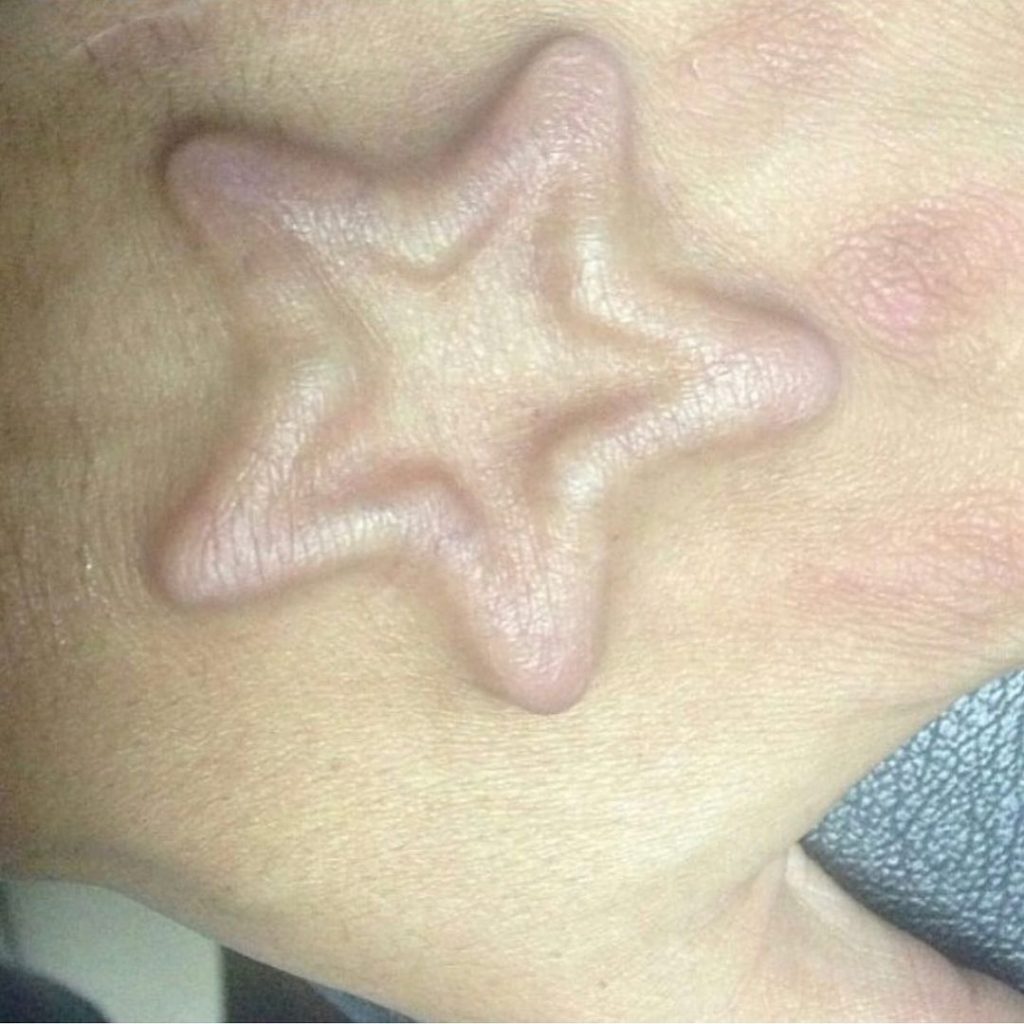 What is Subdermal Implant? - Body Art Guru