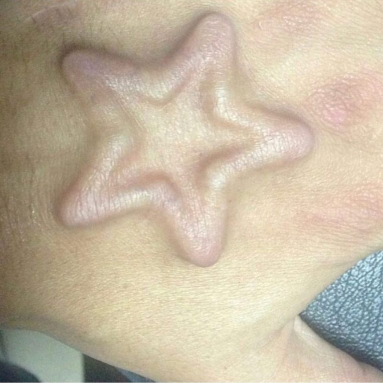 What is Subdermal Implant? - Body Art Guru