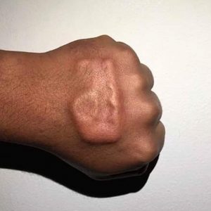 What is Subdermal Implant? - Body Art Guru