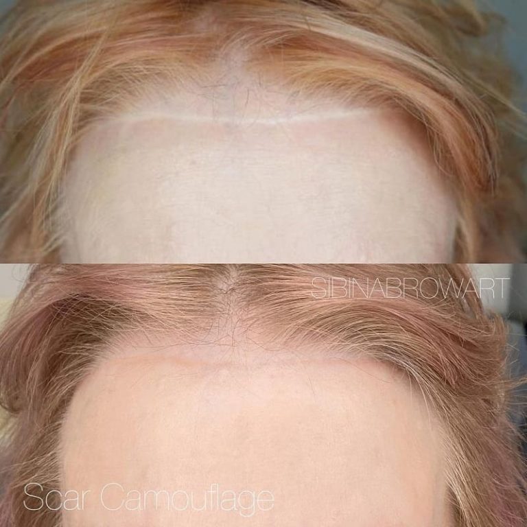 Tattoos For Hiding Scars: Scar Camouflage - Body Art Guru